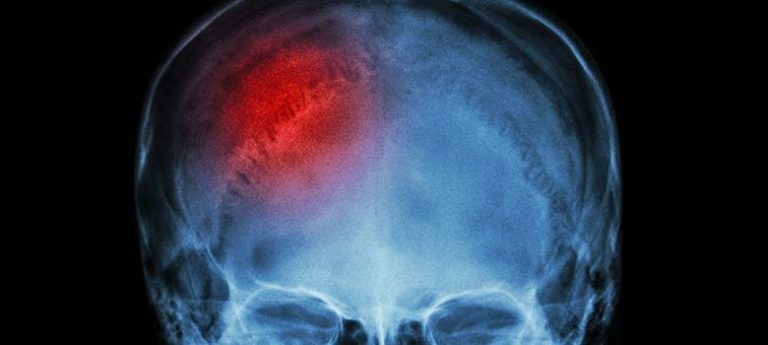 Kafa Travması Subdural Hematom Nedir? | İlaç Çeşitleri